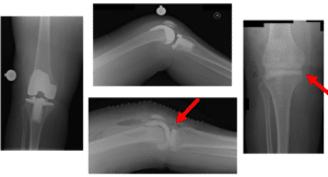Total Knee Replacement Articulating Antibiotic Spacer | NYHK