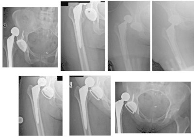 Recurrent Total Hip Arthroplasty (THA) Dislocation | NY, USA