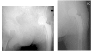 Left Total Hip Arthroplasty | A Case Study by Dr. Karkare