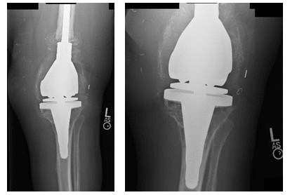 Limb Surgery with Articulating Antibiotic Spacer | NYHK