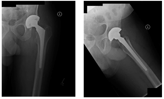 Loosening Left Total Hip Arthroplasty | NY, USA