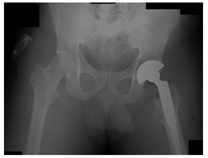 Loosening Left Total Hip Arthroplasty | NY, USA