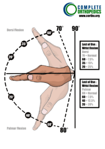 Workers compensation Scheduled Loss of Use for Hand and Wrist | Best ...